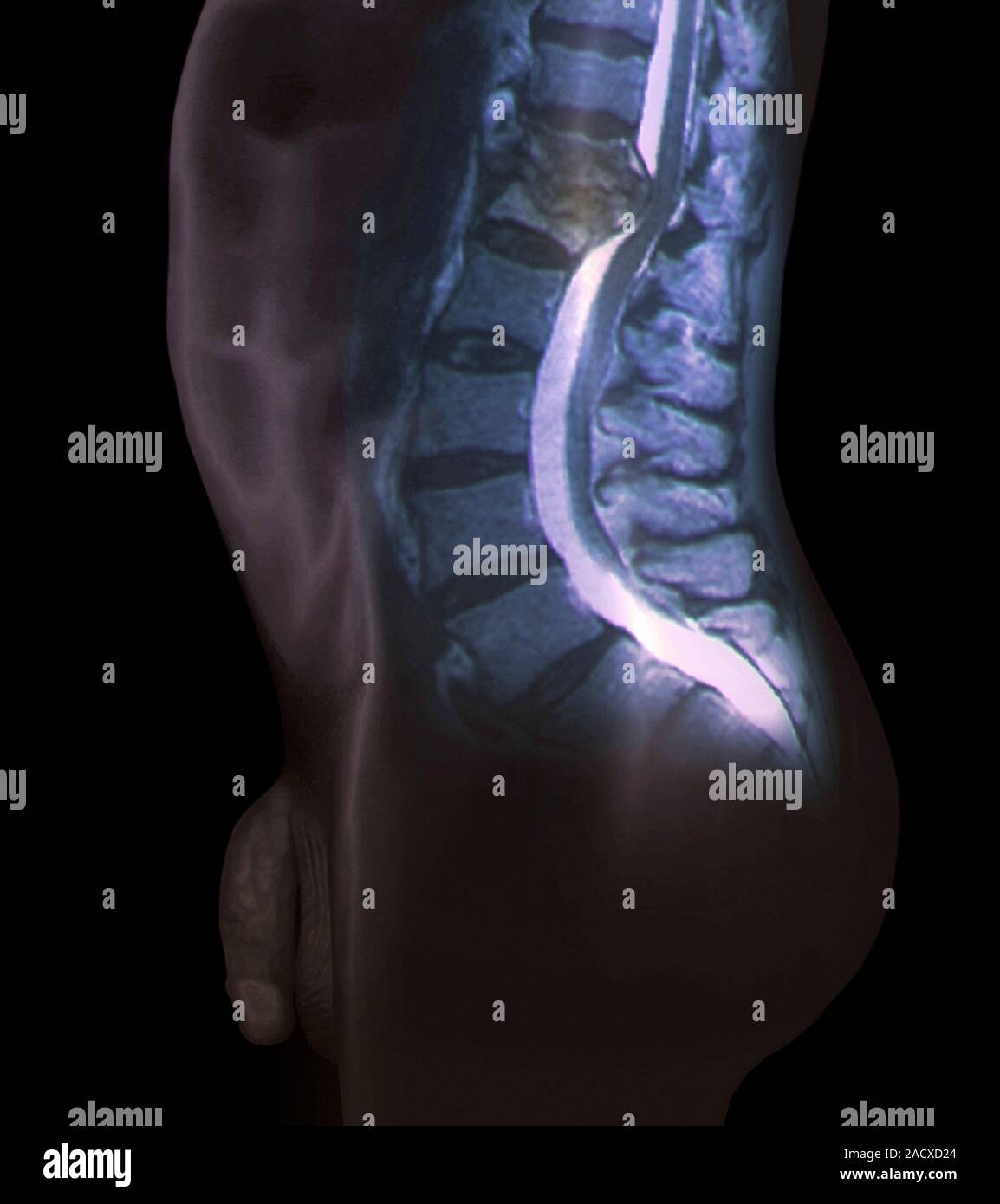 Pott's disease. Coloured magnetic resonance imaging (MRI) scan of a 43 ...
