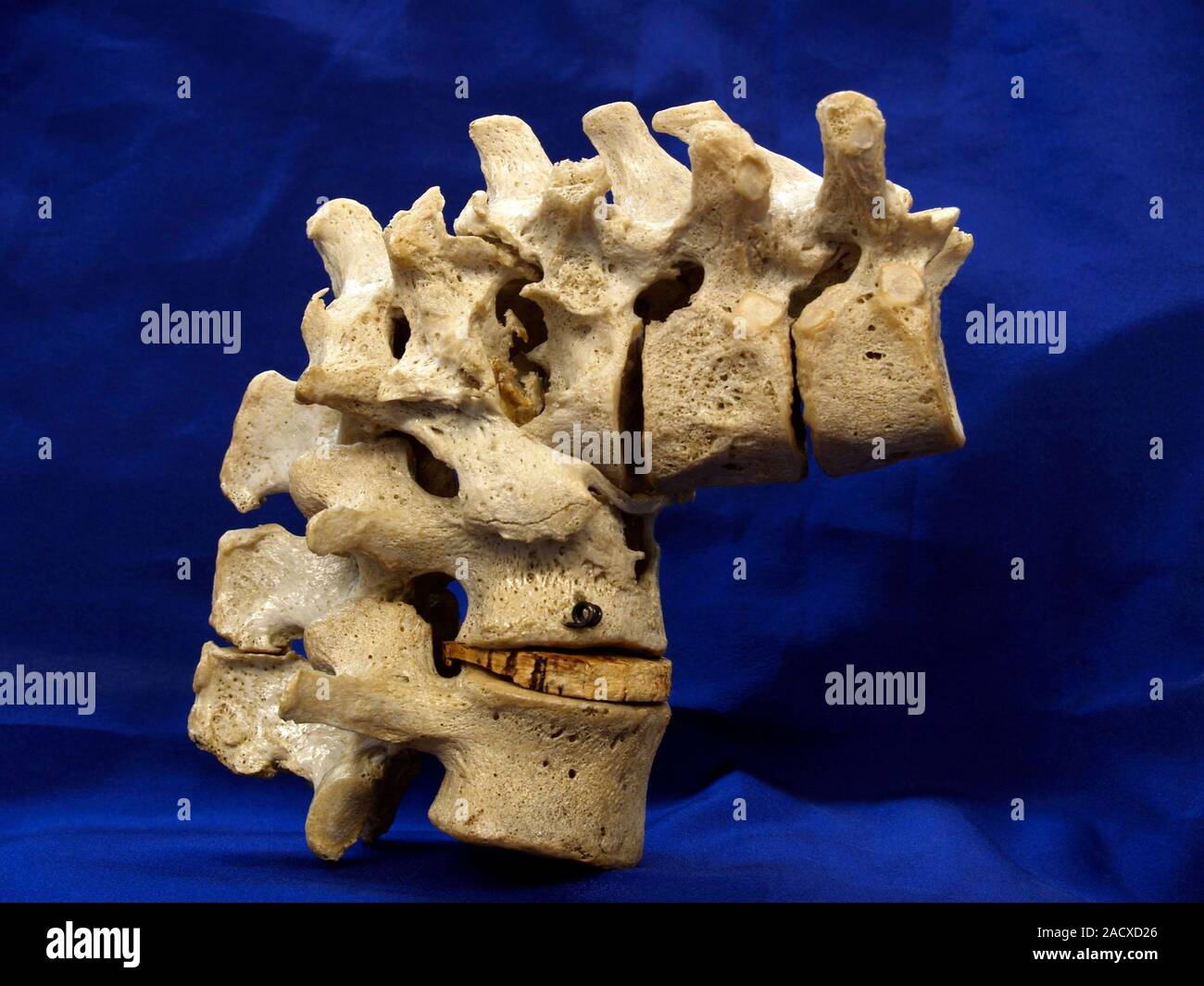 Tuberculosis Of The Spine Gross Specimen Of A Spine Infected With Tuberculosis Tb A