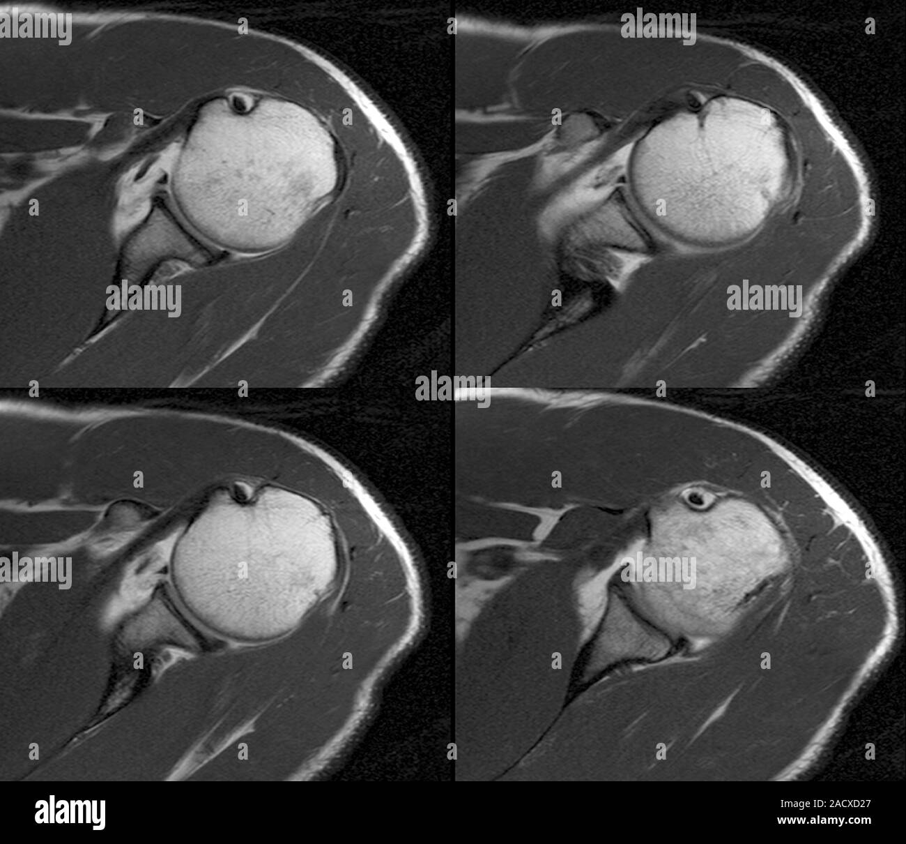 Healthy glenohumeral (shoulder) joint. Magnetic resonance imaging (MRI ...
