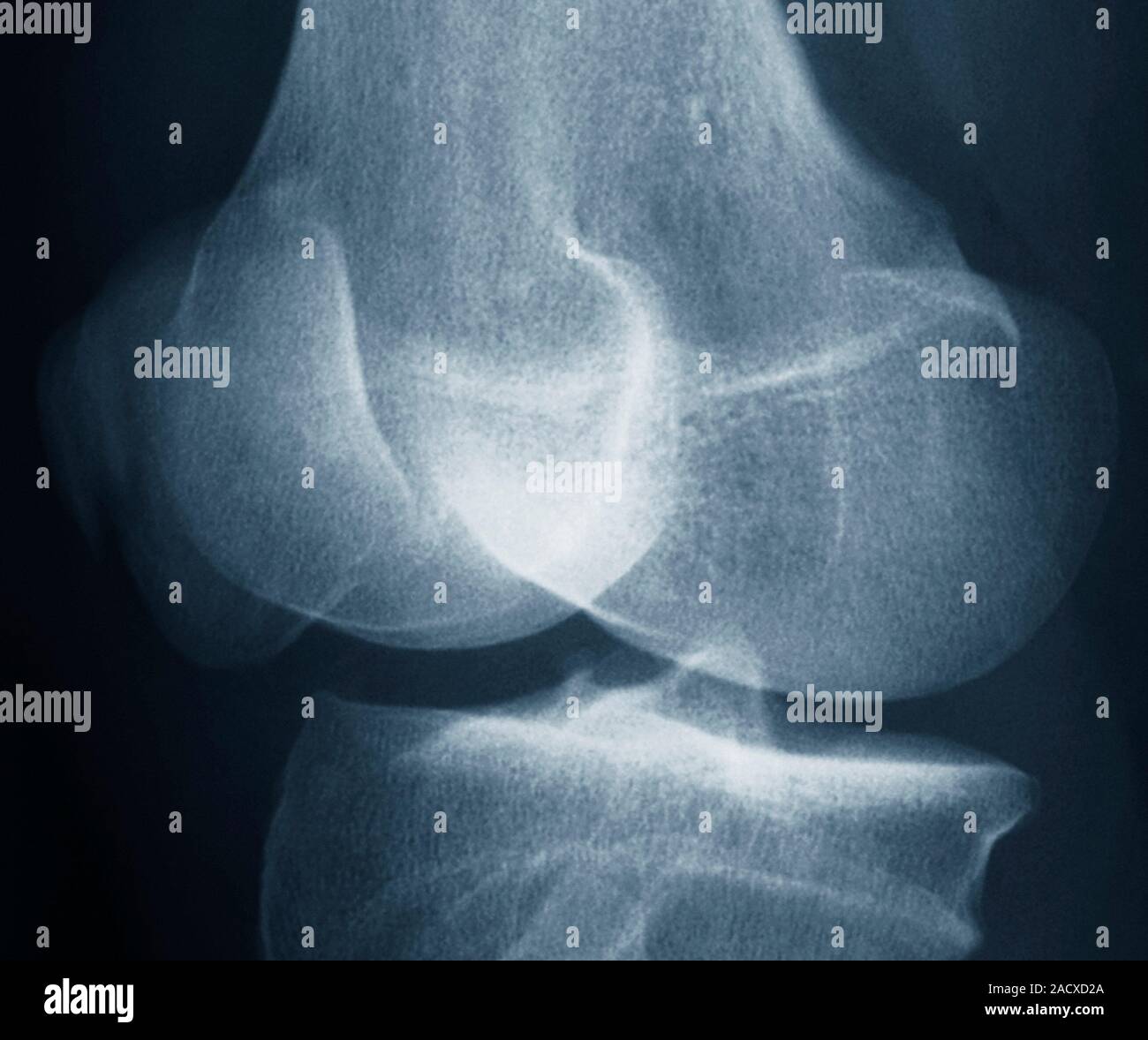 Fractured patella (knee cap). Coloured x-ray of a 42 year old woman's ...
