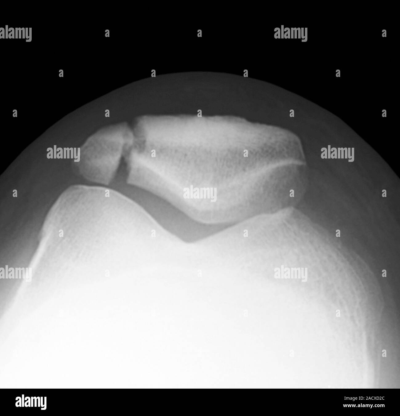 Fractured patella (knee cap). X-ray of a 42 year old woman's right knee ...