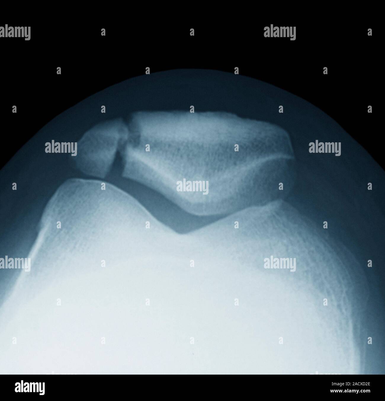 Fractured patella (knee cap). Coloured x-ray of a 42 year old woman's ...
