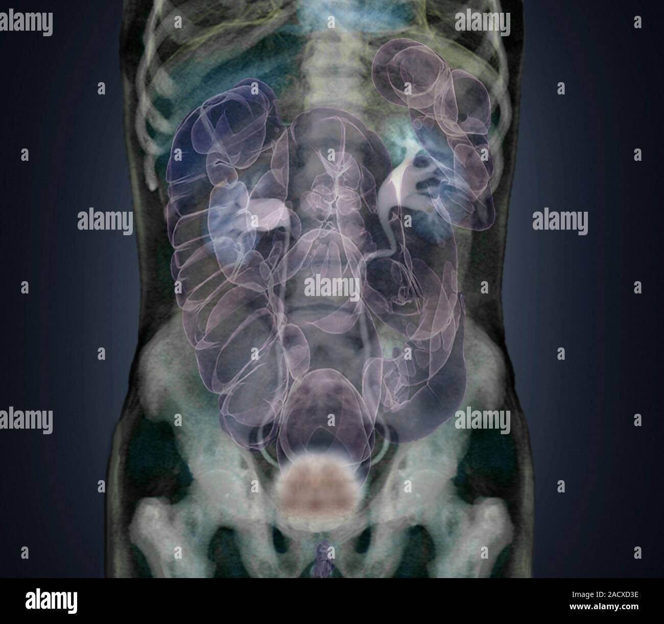 Healthy abdomen. Composite image combining an intravenous urography x ...