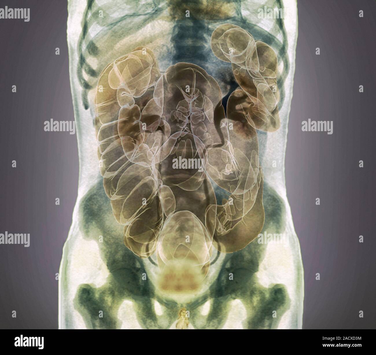 Healthy abdomen. Composite image combining an intravenous urography x ...