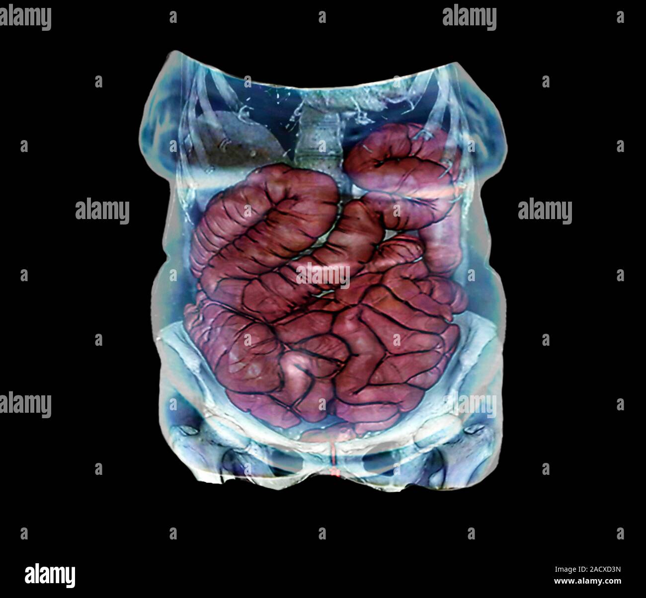 3D computed tomography (CT) scan of the large intestine of an obese 52 ...