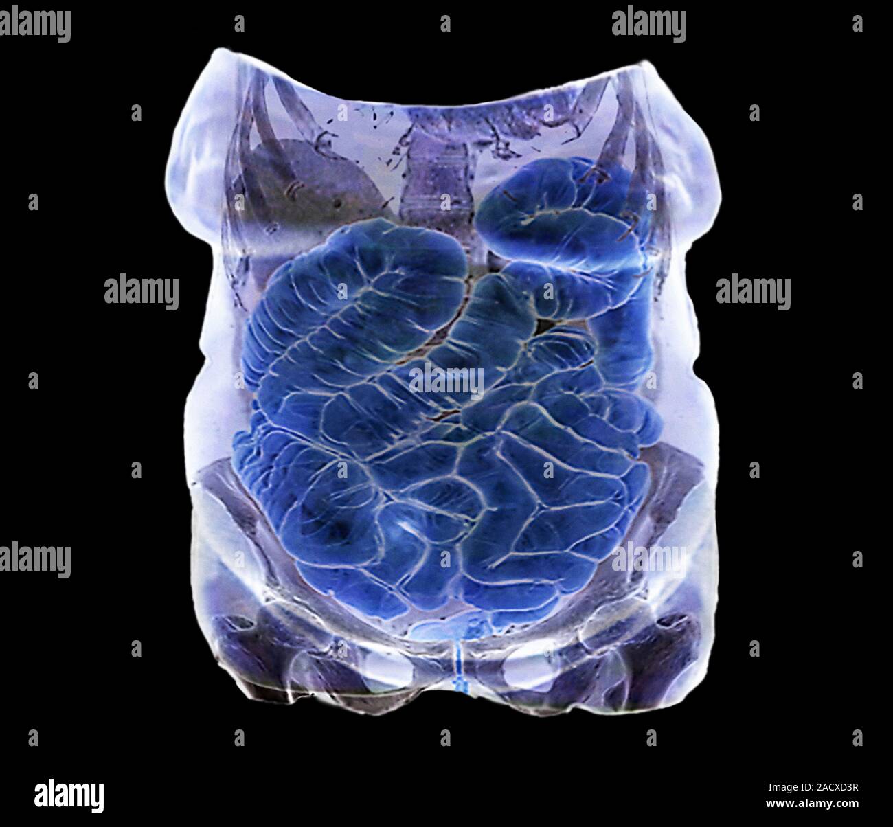 3D computed tomography (CT) scan of the large intestine of an obese 52 ...