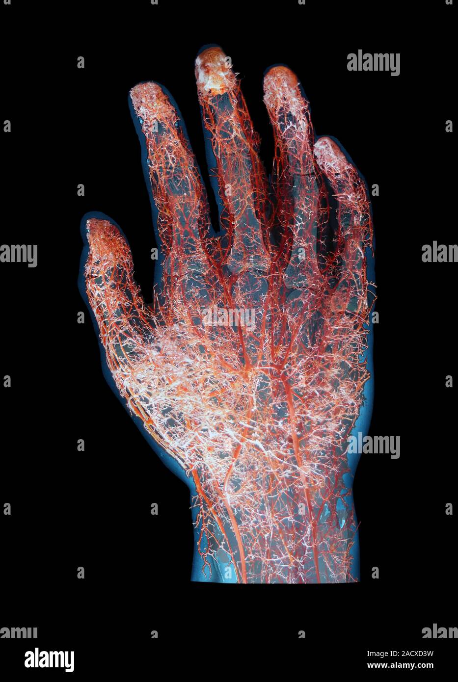 Plastic corrosion cast of the blood vessels of the human hand ...