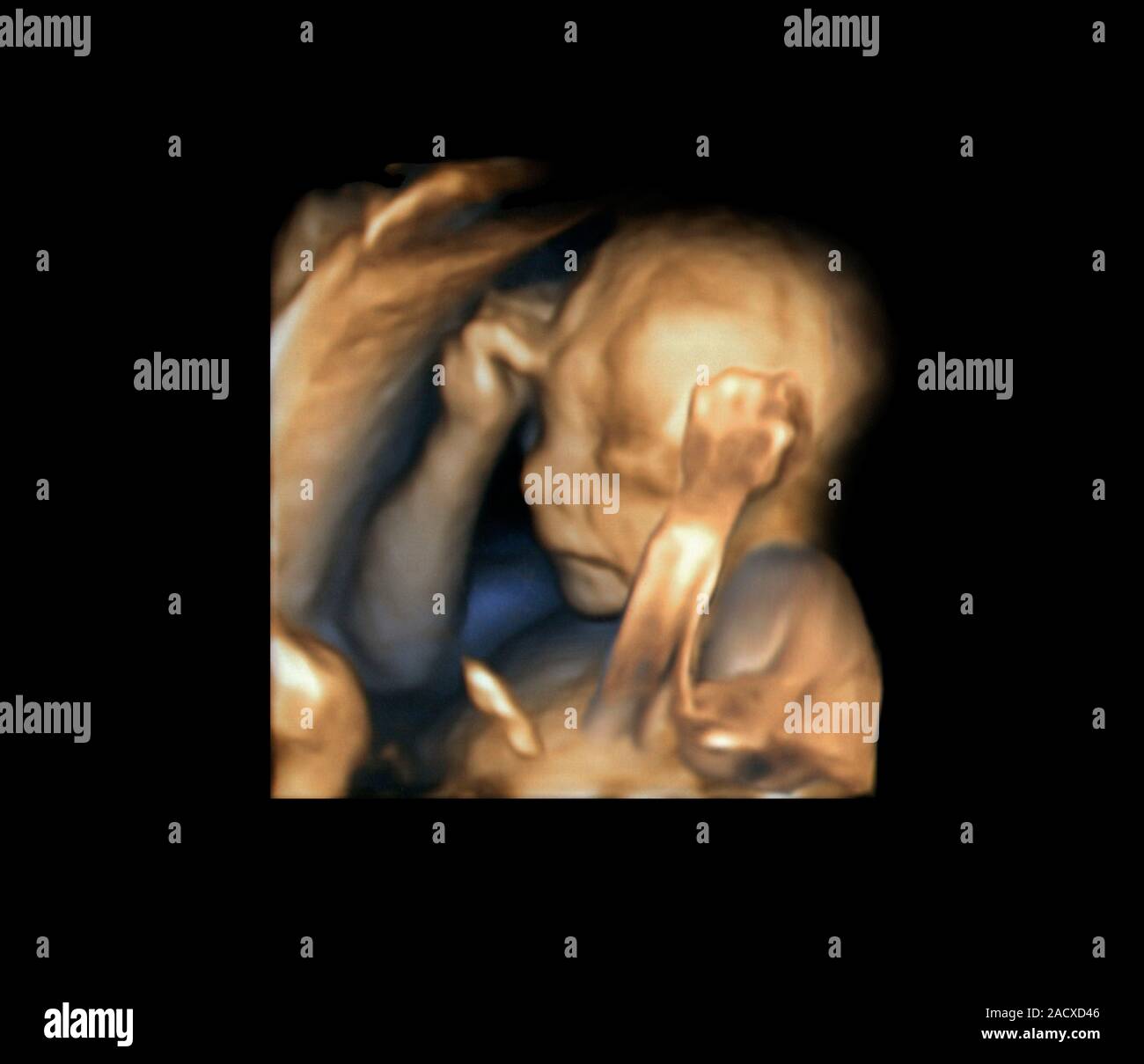 Healthy foetus at around the 20th week of development, coloured 3D ...