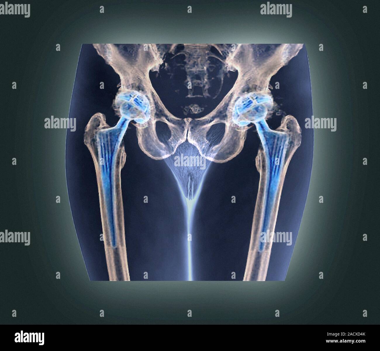 Double hip replacement. Coloured 3D computed tomography (CT) scan of a ...