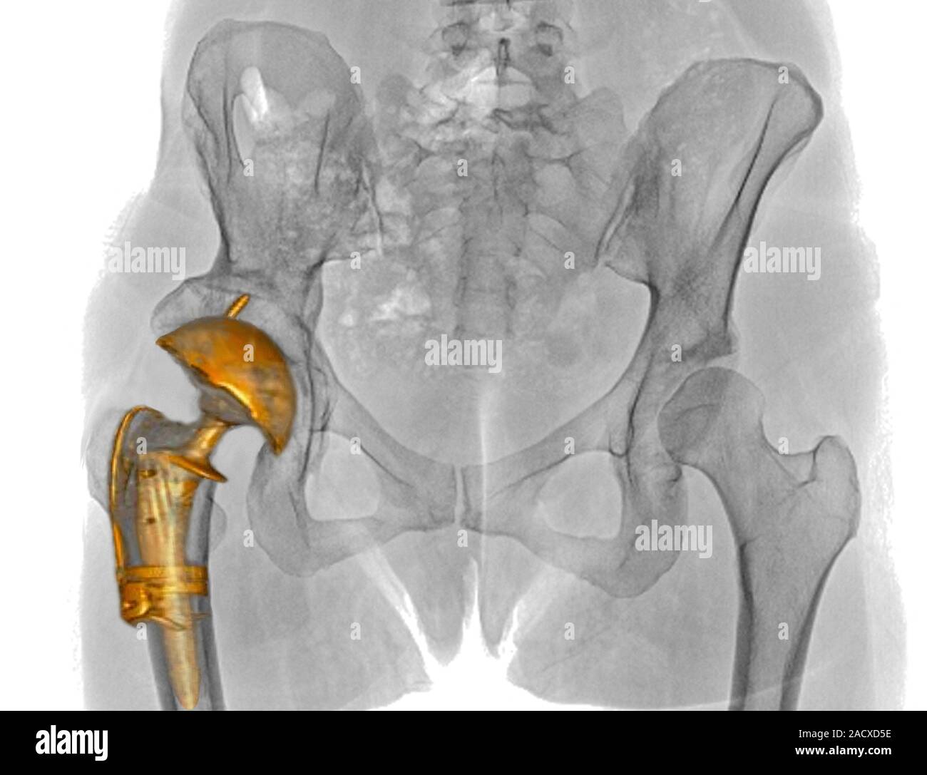 Hip replacement. Coloured 3D computed tomography (CT) scan of a 52 year ...