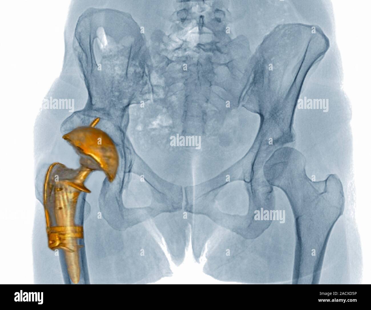 Hip replacement. Coloured 3D computed tomography (CT) scan of a 52 year ...