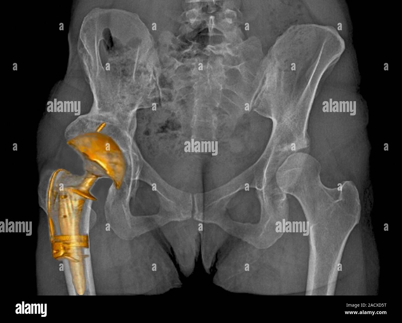 Hip replacement. Coloured 3D computed tomography (CT) scan of a 52 year ...
