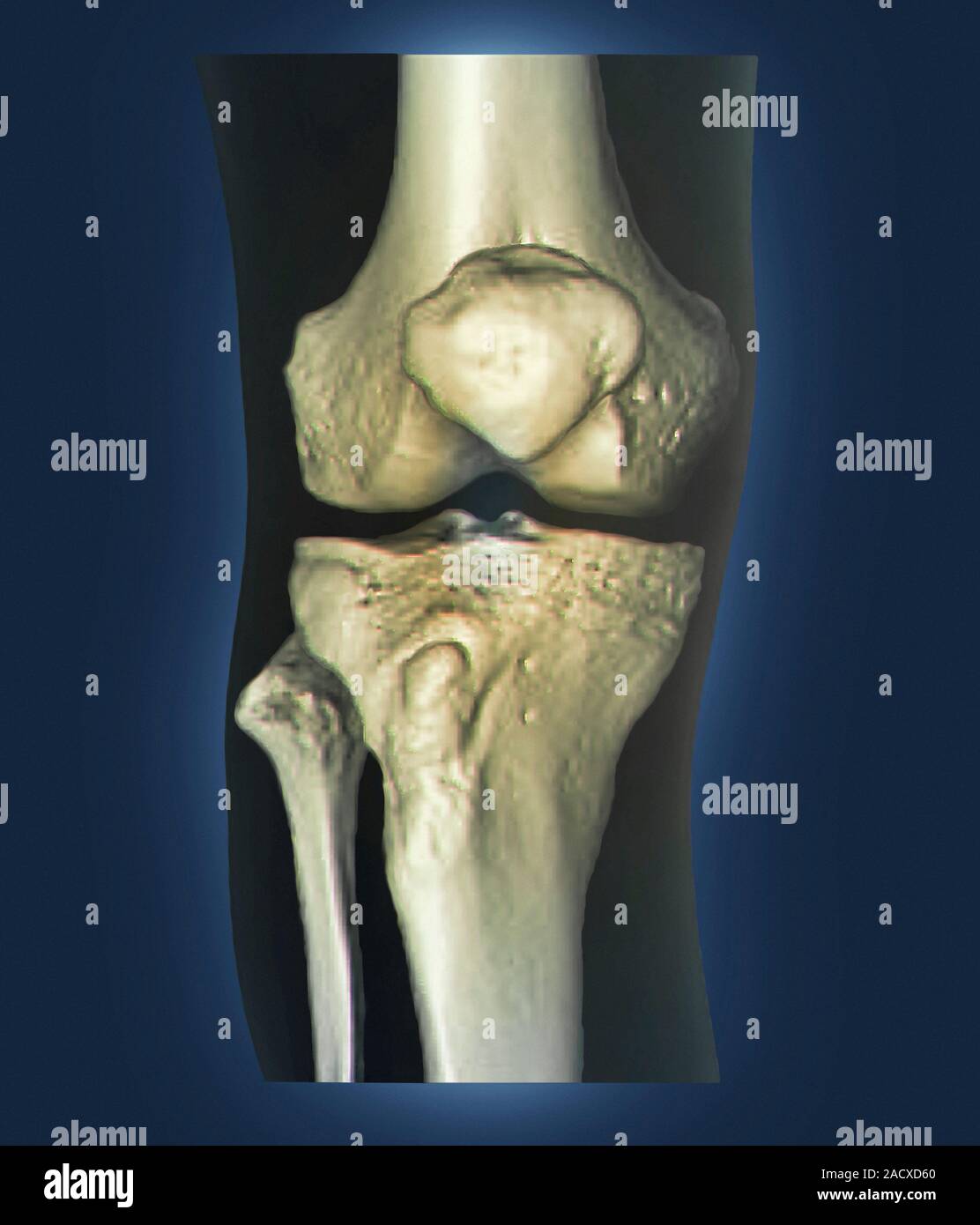 Healthy knee. Coloured 3D computed tomography (CT) scan of the knee of ...