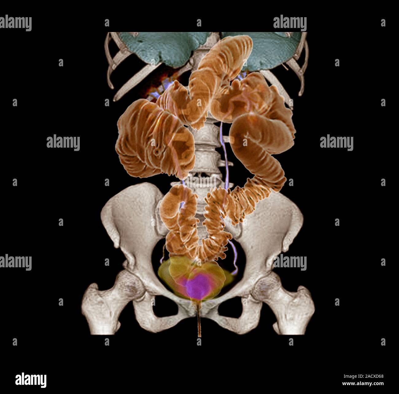 Diverticulosis. 3D computed tomography (CT) scan of the colon (brown ...