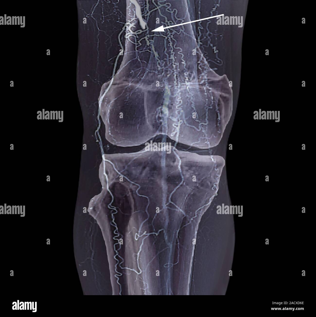 Coloured 3D computed tomography (CT) angiogram of the left leg of a 56 ...