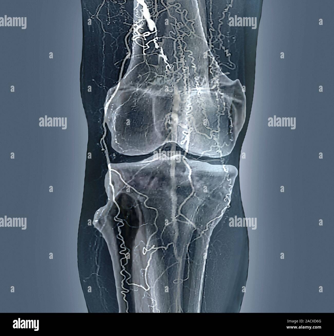 Coloured 3D computed tomography (CT) angiogram of the left leg of a 56 ...