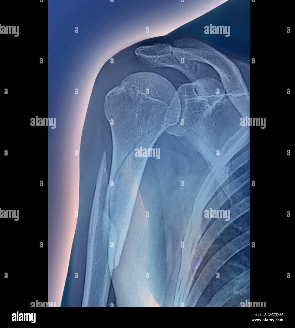 Broken arm. Coloured X-ray of a 27 year old woman's broken right ...