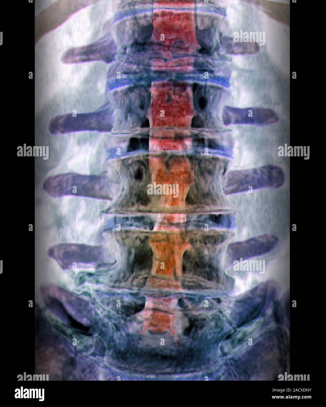 Slipped disc. Coloured 3D computed tomography (CT) scan of the lumbar ...