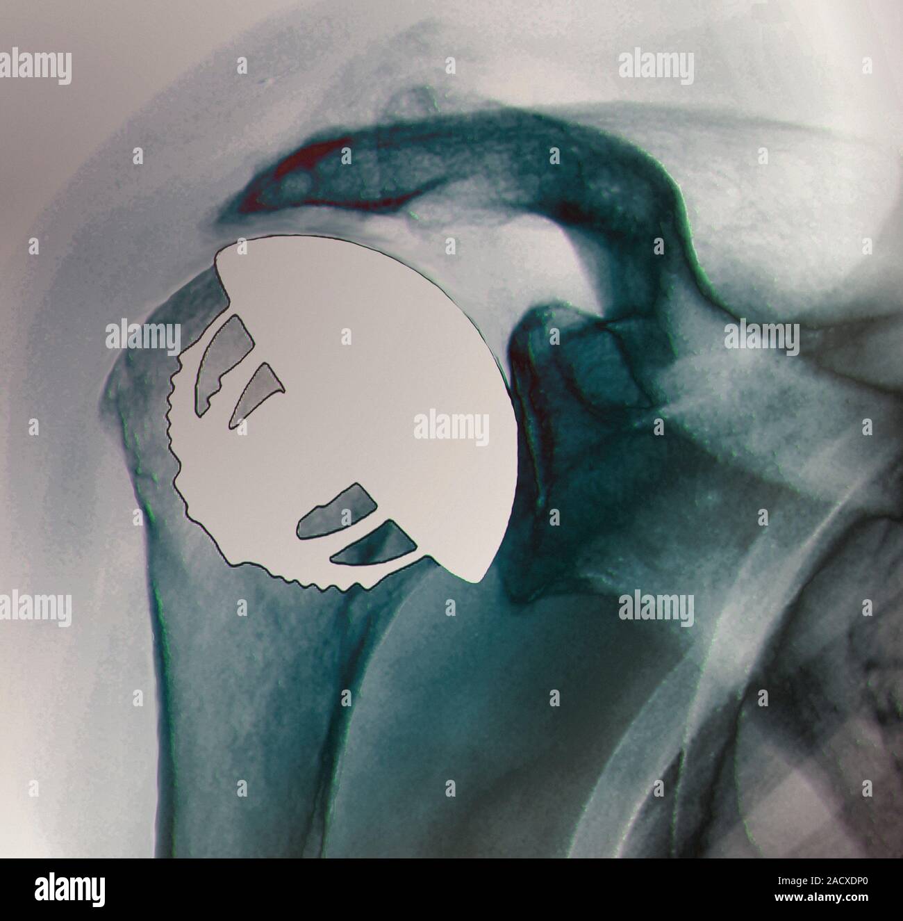 Shoulder replacement. Coloured x-ray of an artificial shoulder joint in ...