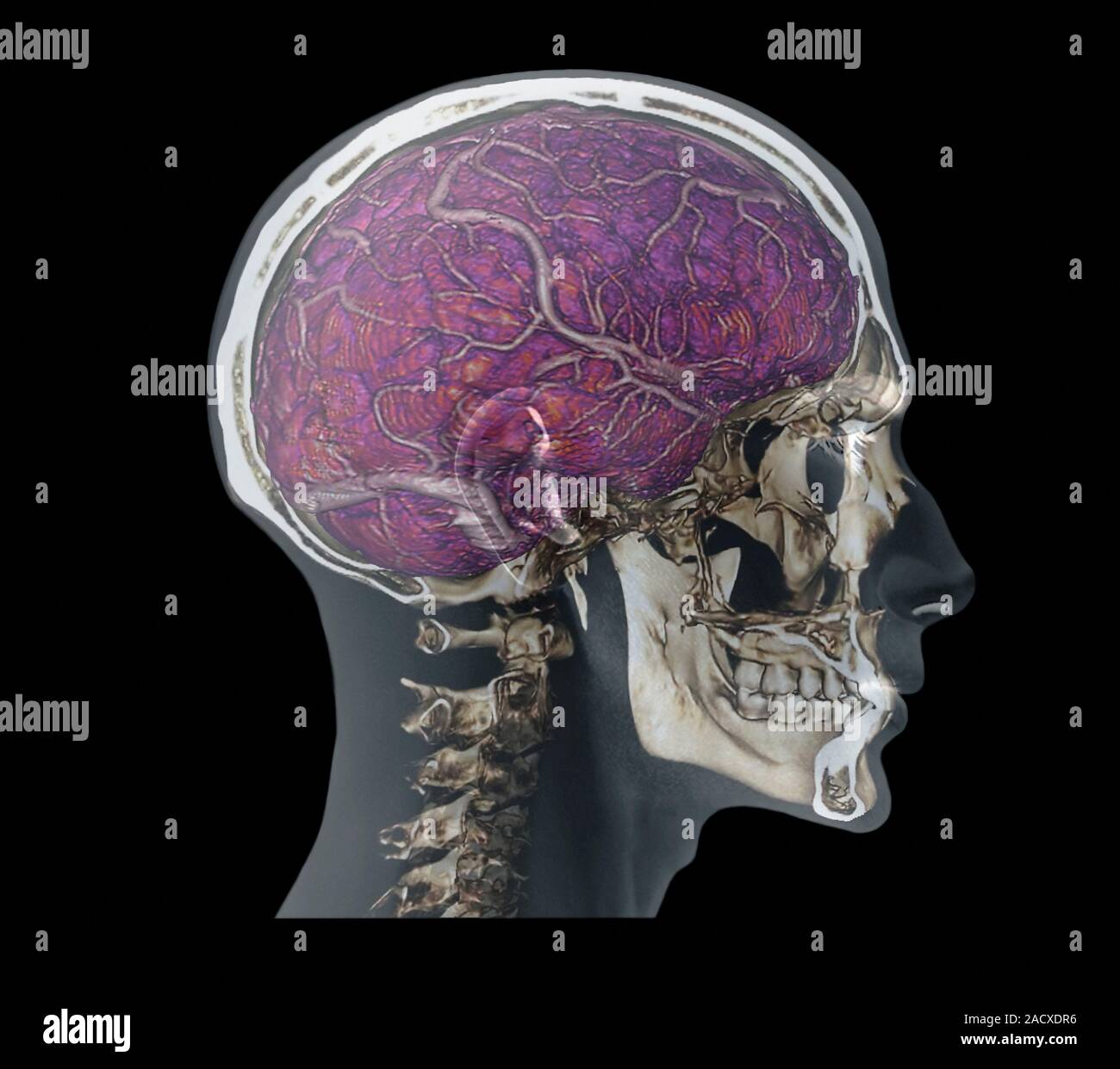 Human head. Coloured composite image of a magnetic resonance imaging (MRI) scan of the brain and ...