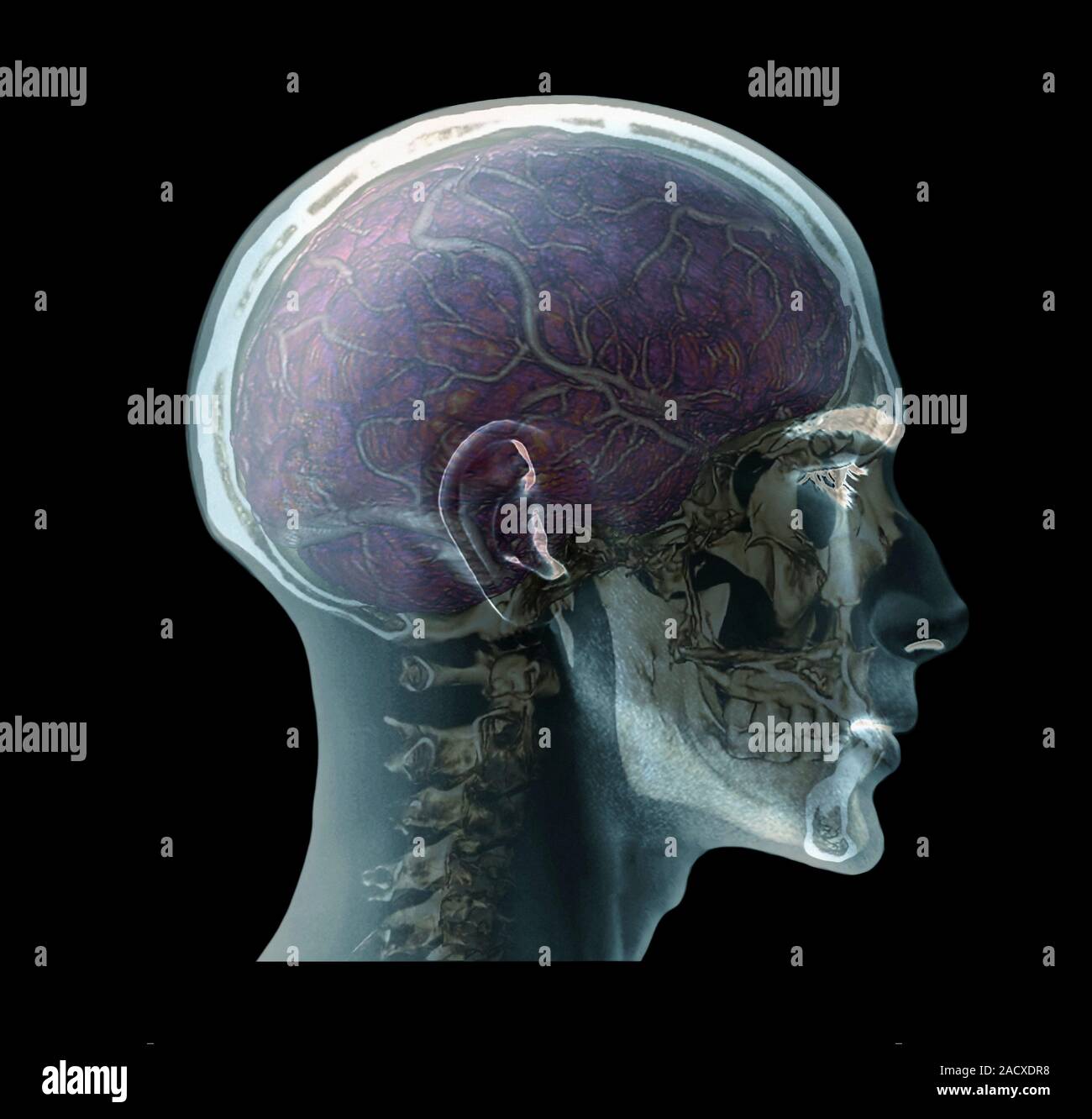 Human head. Coloured composite image of a magnetic resonance imaging (MRI) scan of the brain and ...