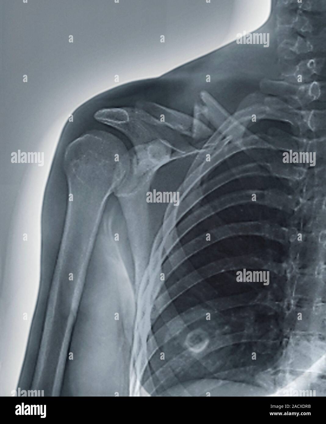 Collar bone fracture. X-ray of a 26 year old woman's right shoulder ...