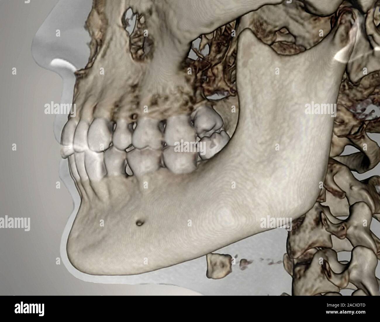 Human jaw. Coloured cone beam computed tomography (CBCT) scan of a ...
