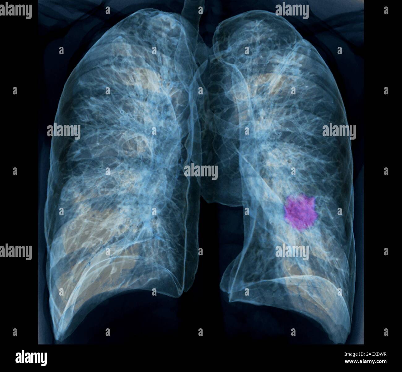 Lung cancer. Coloured frontal 3D computed tomography (CT) scan of a 32 ...