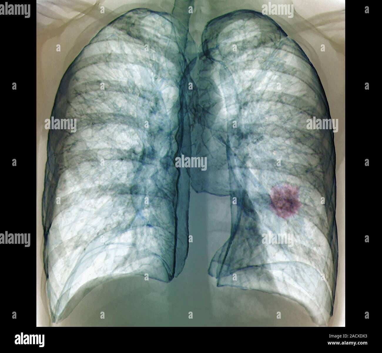 Lung cancer. Coloured frontal 3D computed tomography (CT) scan of a 32 ... Lung cancer. Coloured frontal 3D computed tomography (CT) scan of a 32 ...