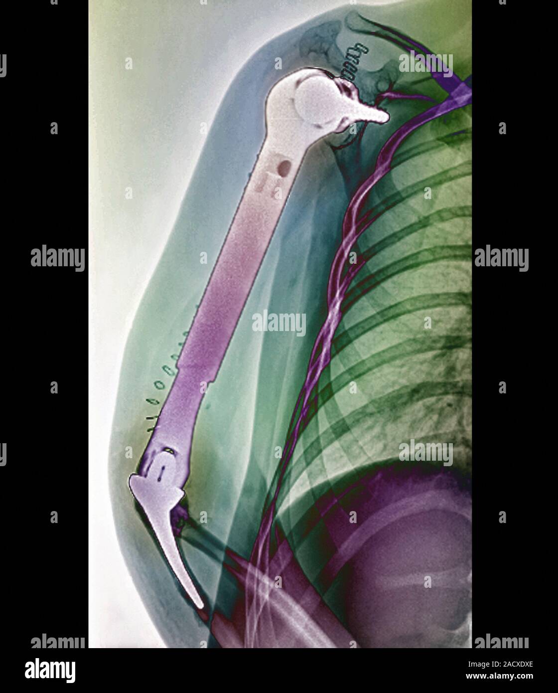 Total upper arm bone replacement. Coloured frontal X-ray of the right ...