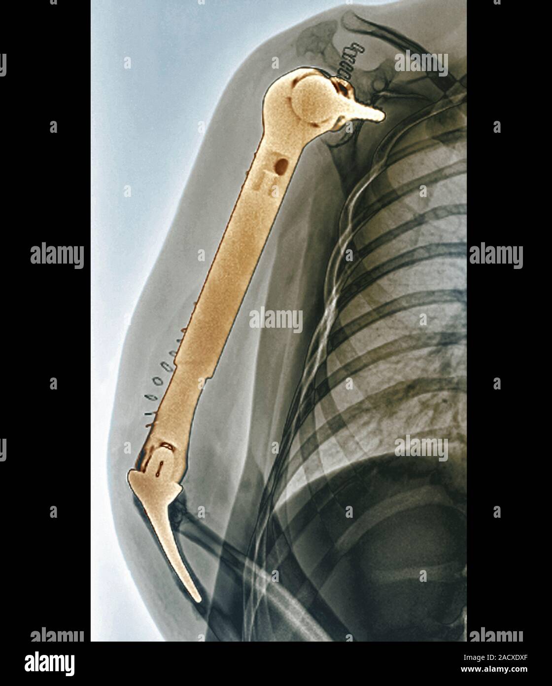 Total upper arm bone replacement. Coloured frontal X-ray of the right ...