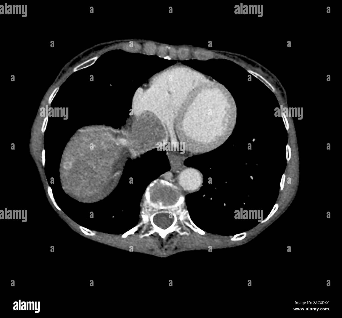 Smooth muscle cancer. Computed tomography (CT) scan of the heart (top ...
