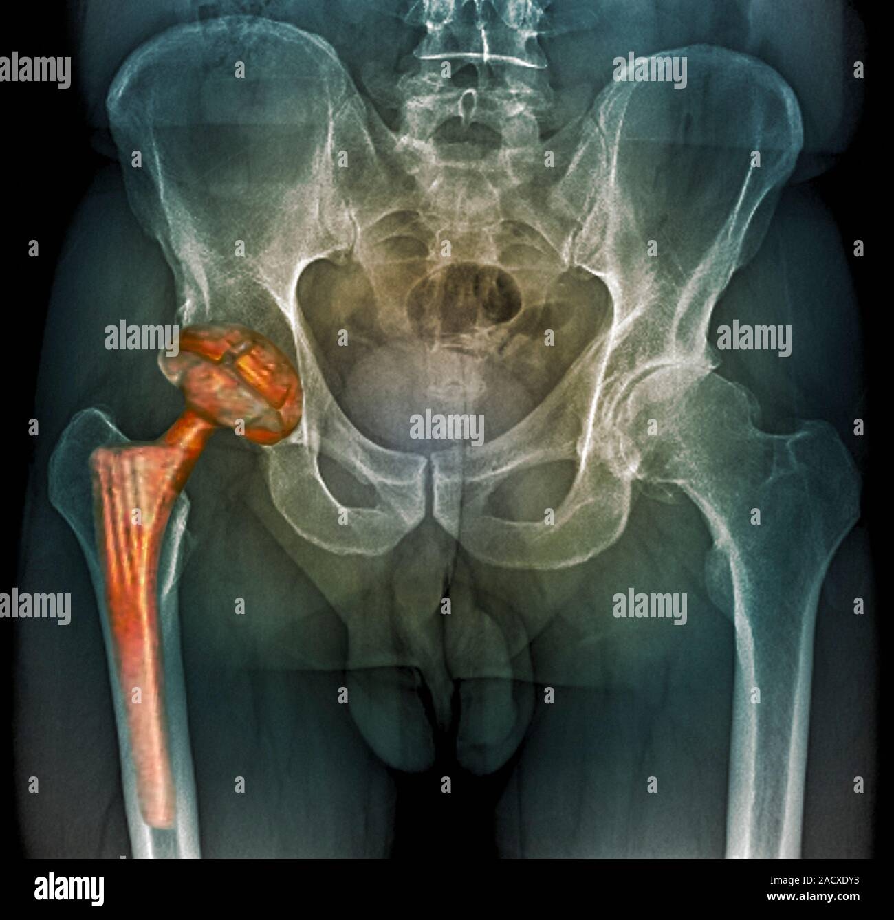 Hip replacement. Coloured 3D computed tomography (CT) scan of a 54 year ...
