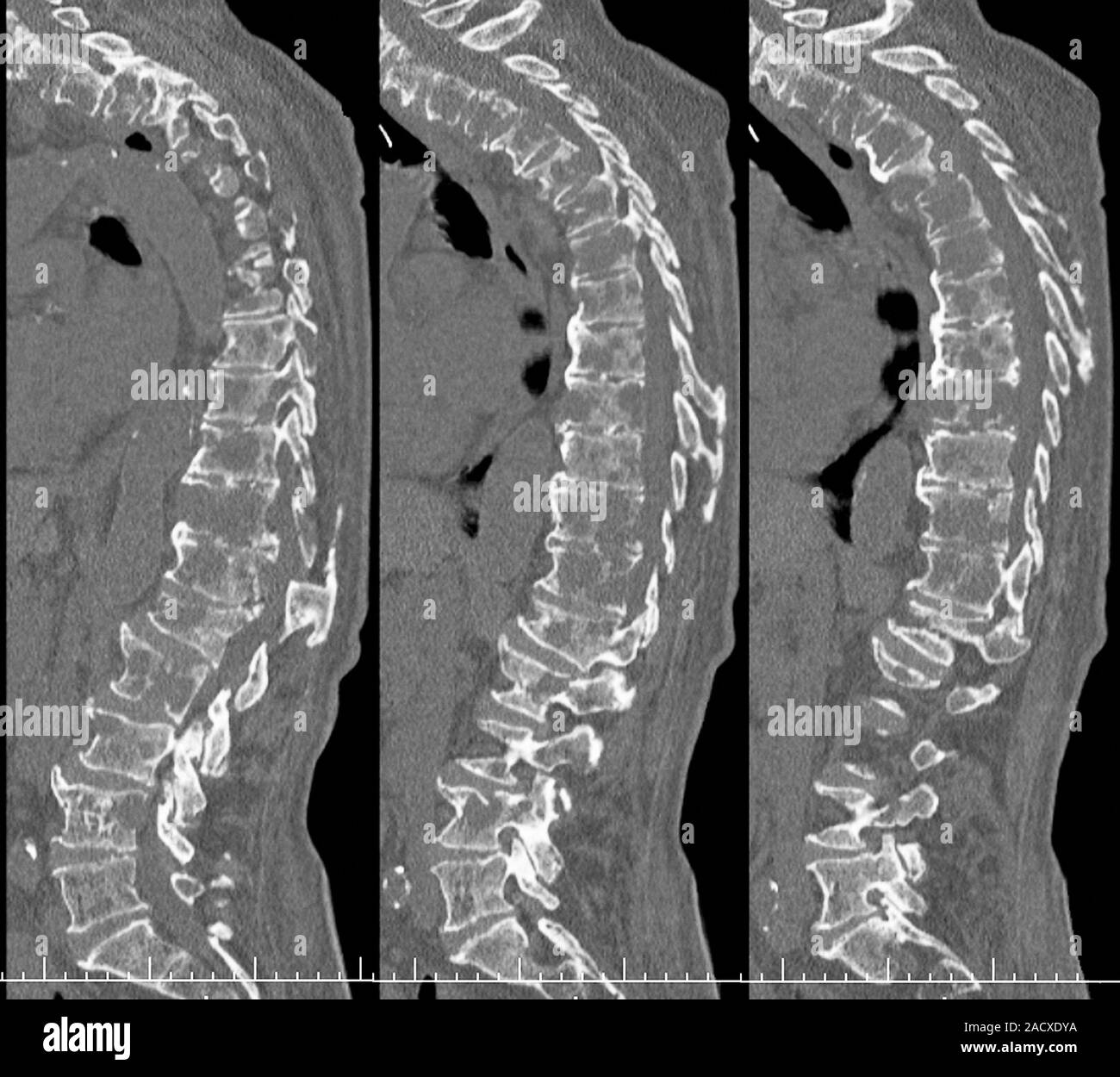 Secondary spinal cancer. Computed tomography (CT) scans of a 70 year ...
