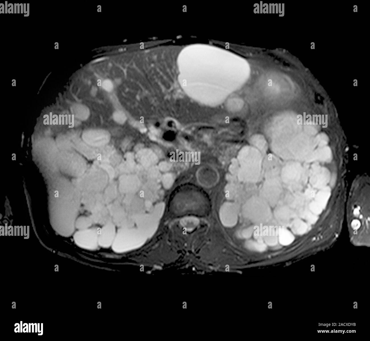 Polycystic disease. Magnetic resonance imaging (MRI) scan of a 57 year ...