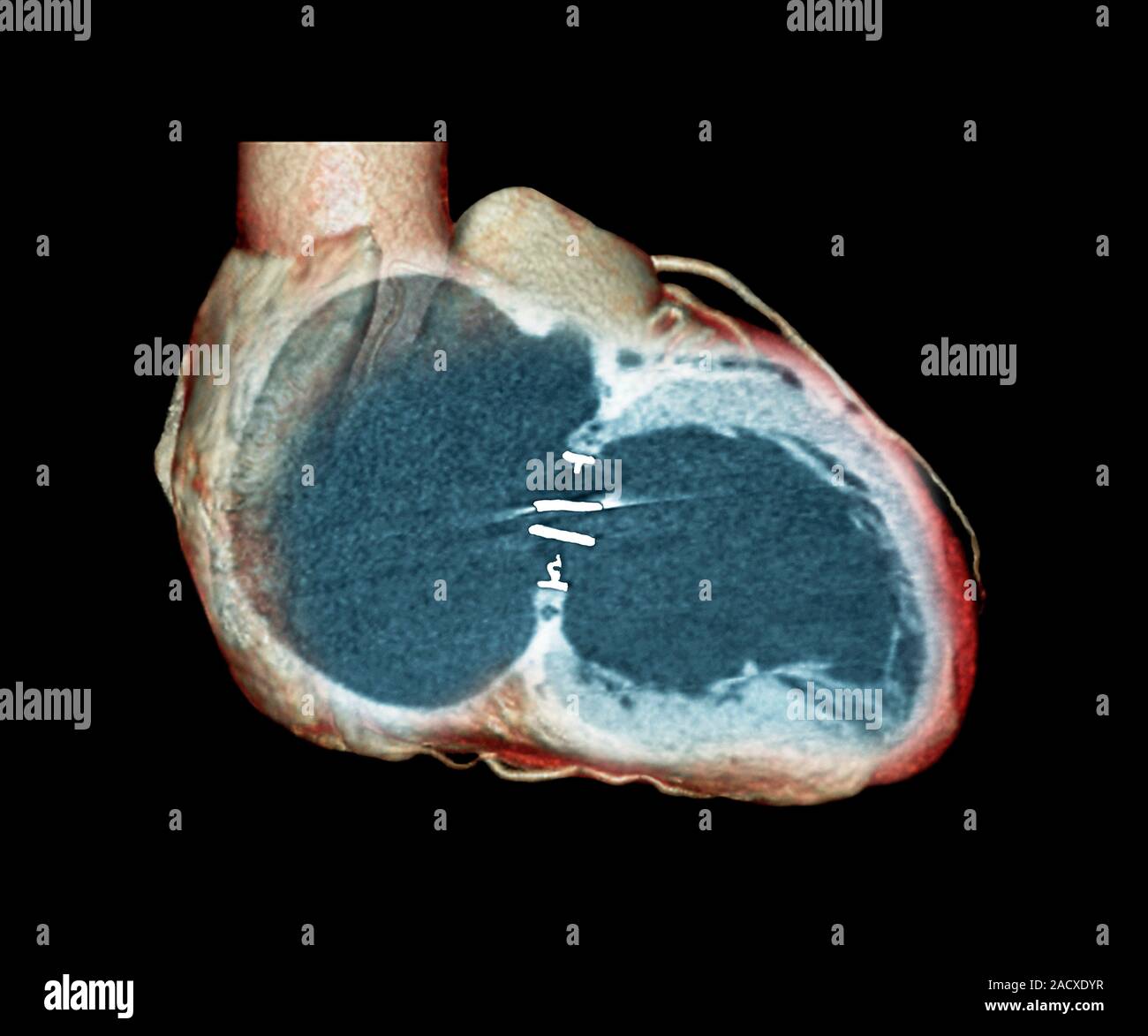 Artificial heart valve. Coloured 3D computed tomography (CT) scan of a ...