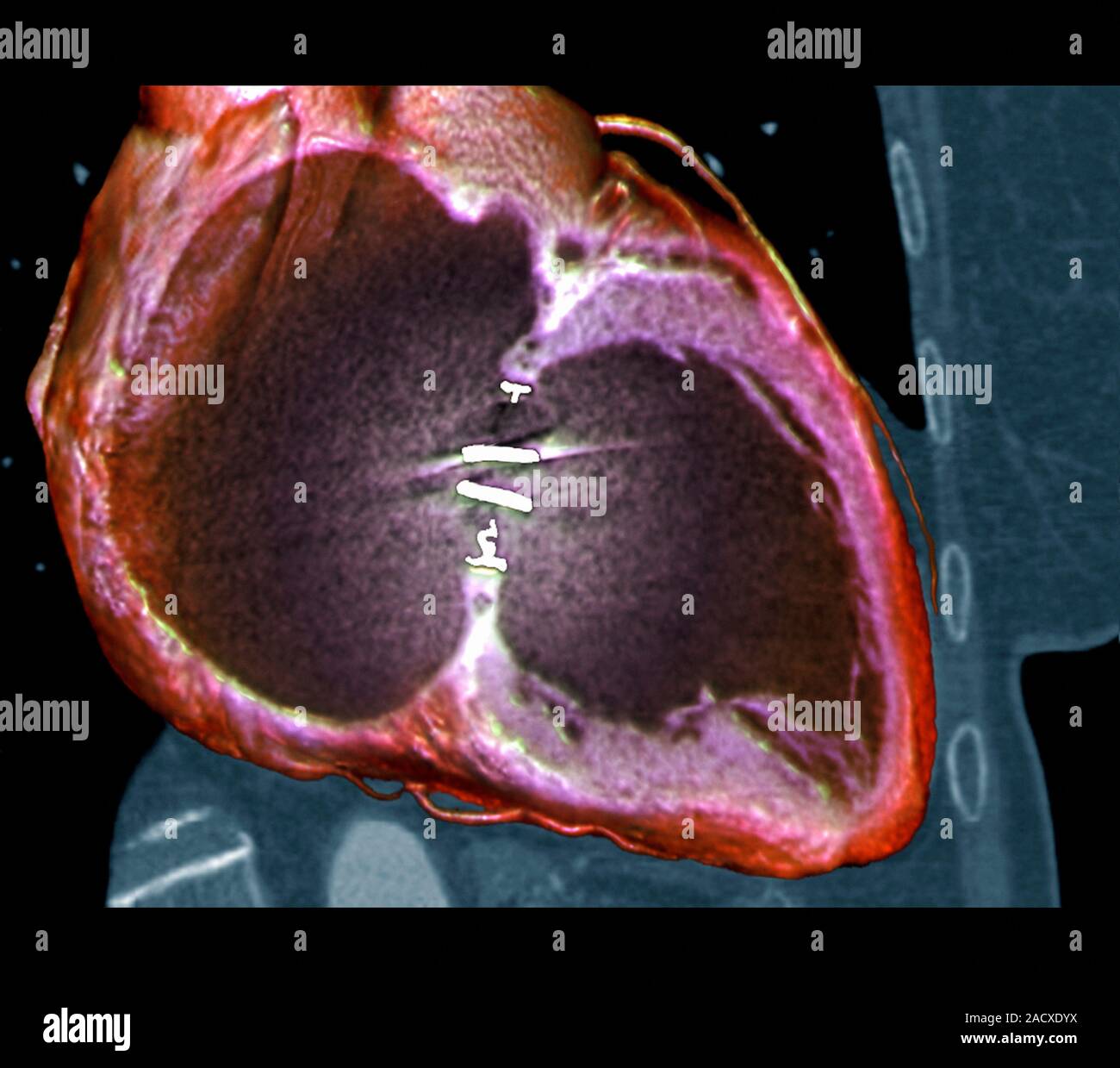 Artificial heart valve. Coloured 3D computed tomography (CT) scan of a ...