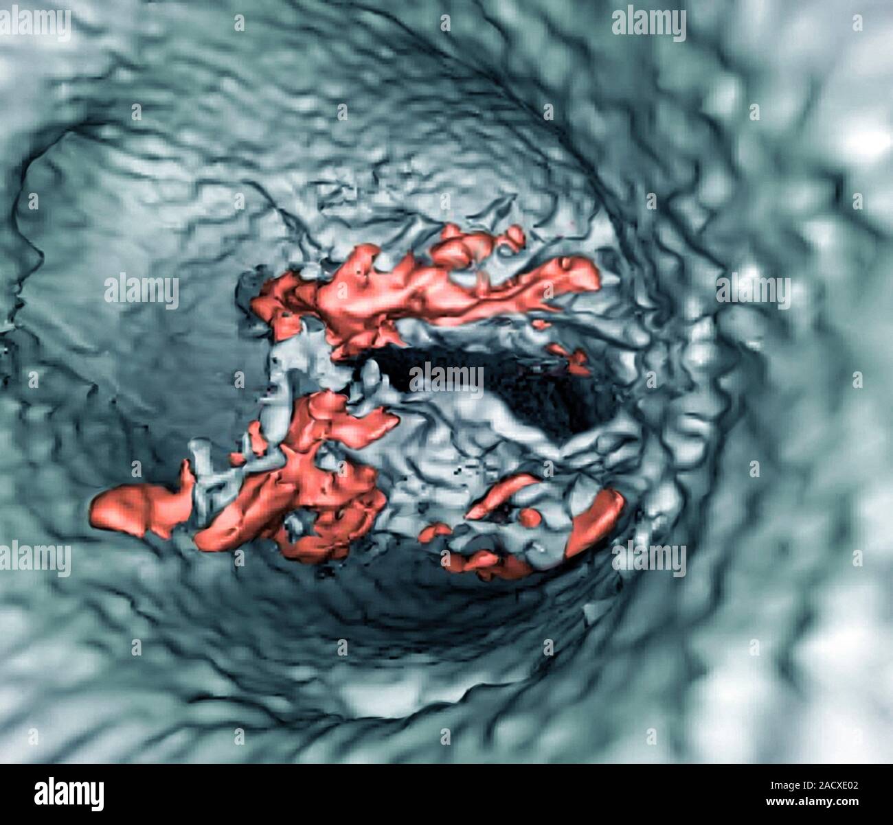 Heart valve disease. Coloured 3D computed tomography (CT) scan of the ...