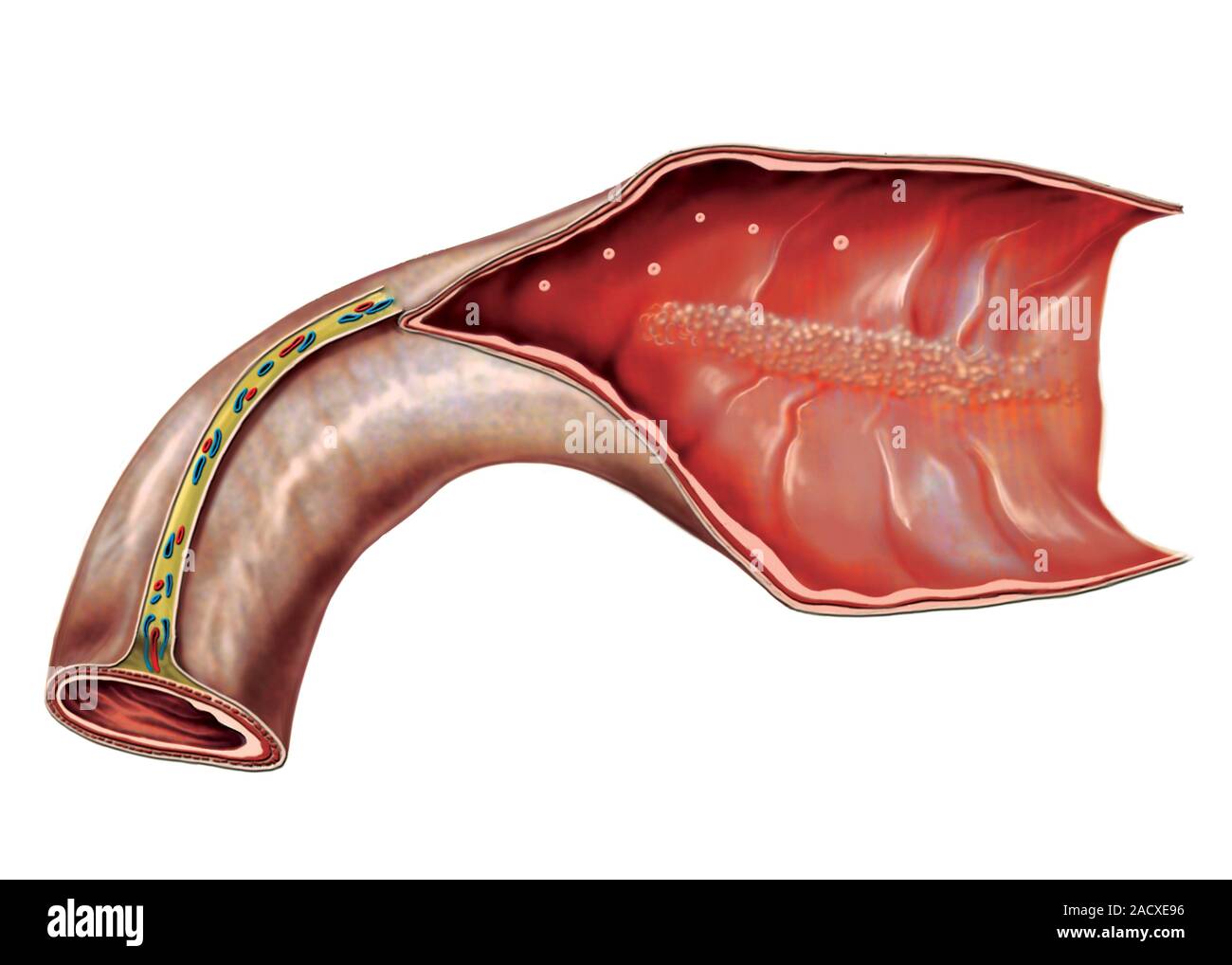 Illustration of the Terminal ileum. This view illustration is from ...