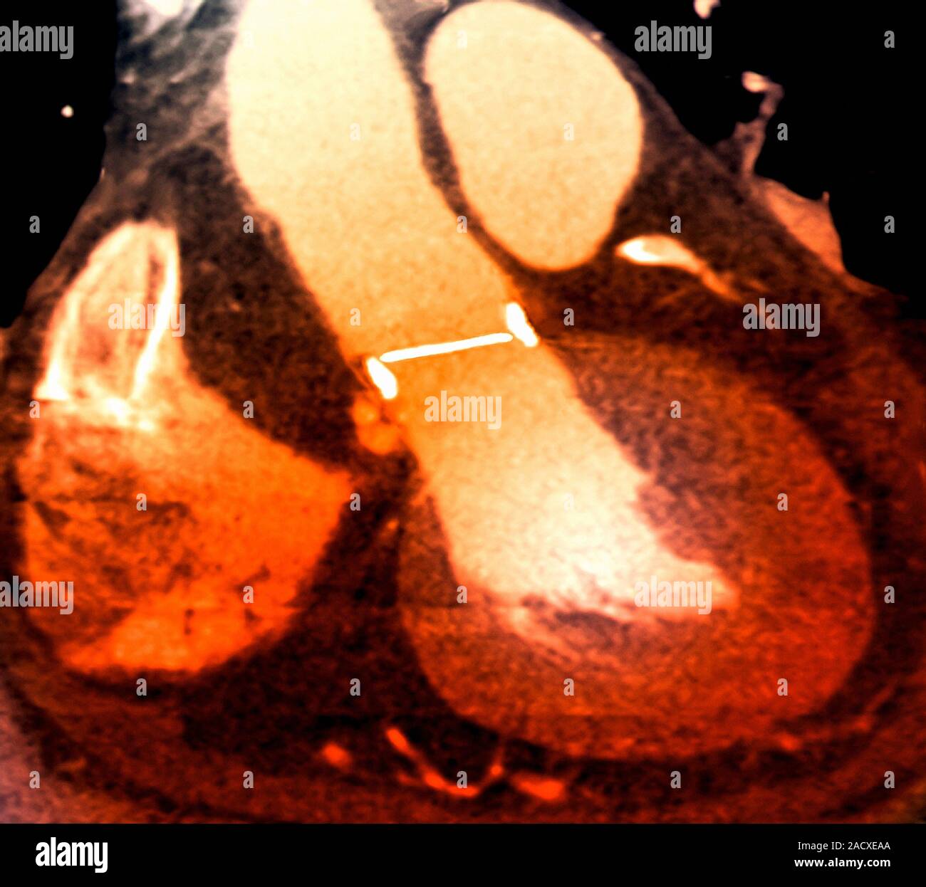 Artificial heart valve. Coloured computed tomography (CT) scan of a ...
