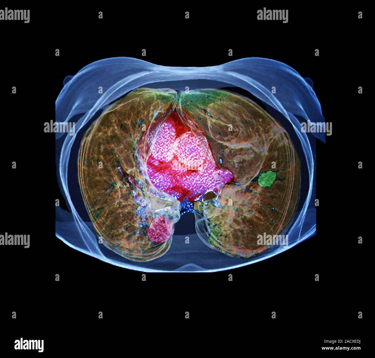 Lung cancer. Coloured computed tomography (CT) scan of a 58 year old ... Lung cancer. Coloured computed tomography (CT) scan of a 58 year old ...
