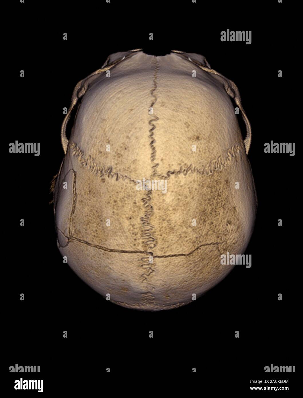 Broken Skull Coloured 3d Computed Tomography Ct Scan Of A 45 Year