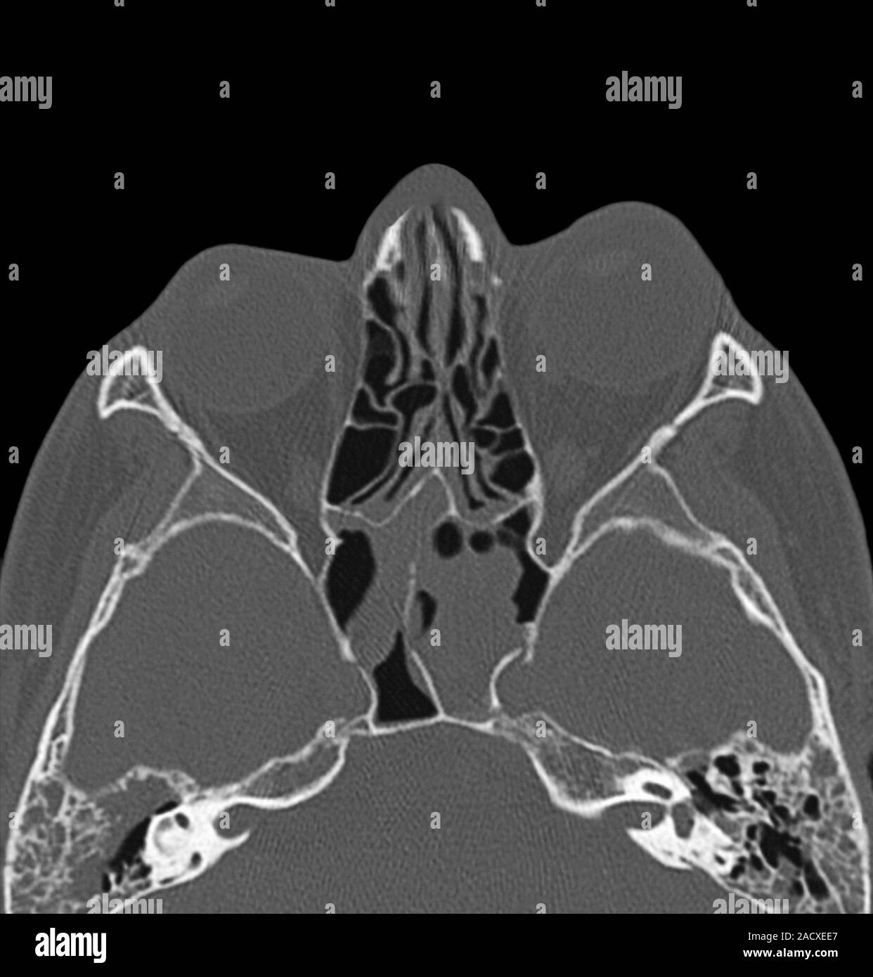 Broken eye socket. Computed tomography (CT) scan of the face (from ...