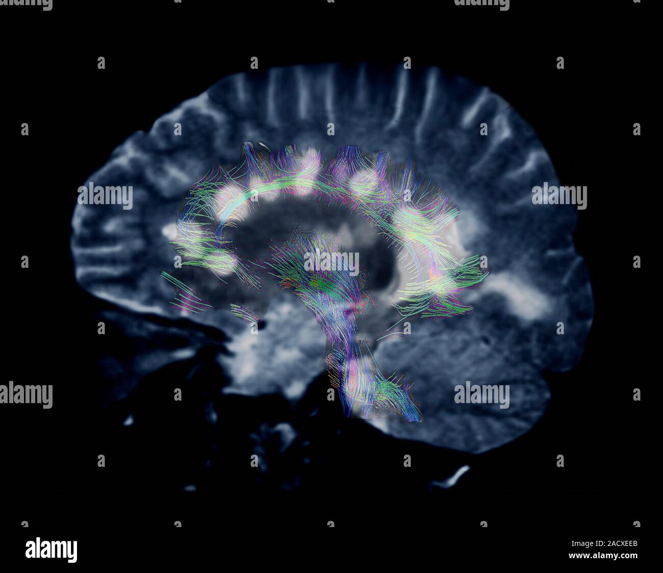 Multiple sclerosis. Coloured magnetic resonance imaging (MRI) scan of the brain, in profile, of ...
