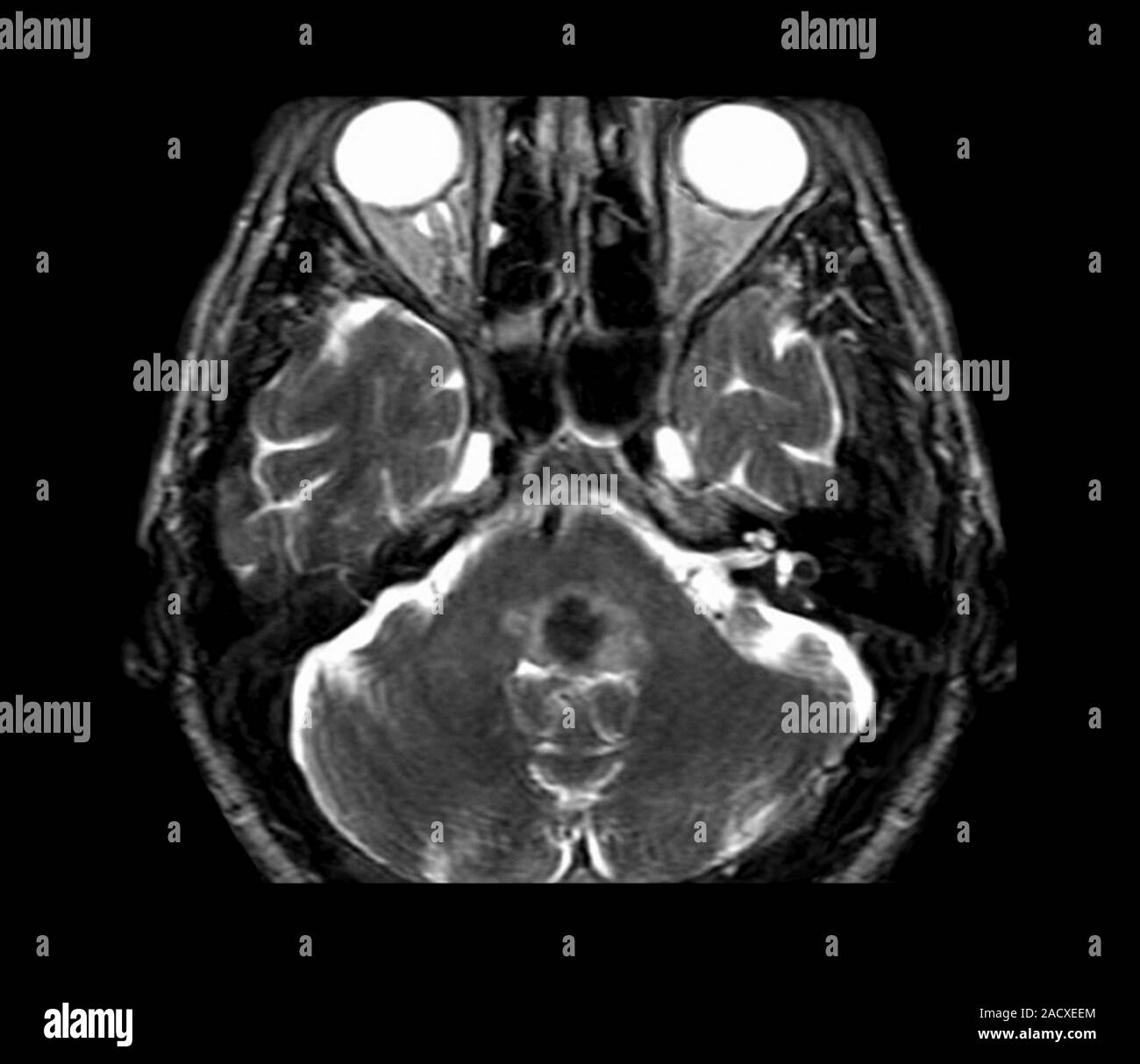 Brain haemorrhage. Magnetic resonance imaging (MRI) scan of the ...