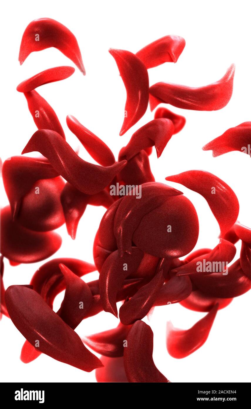 Sickle cell anaemia. Artwork showing normal red blood cells (round ...