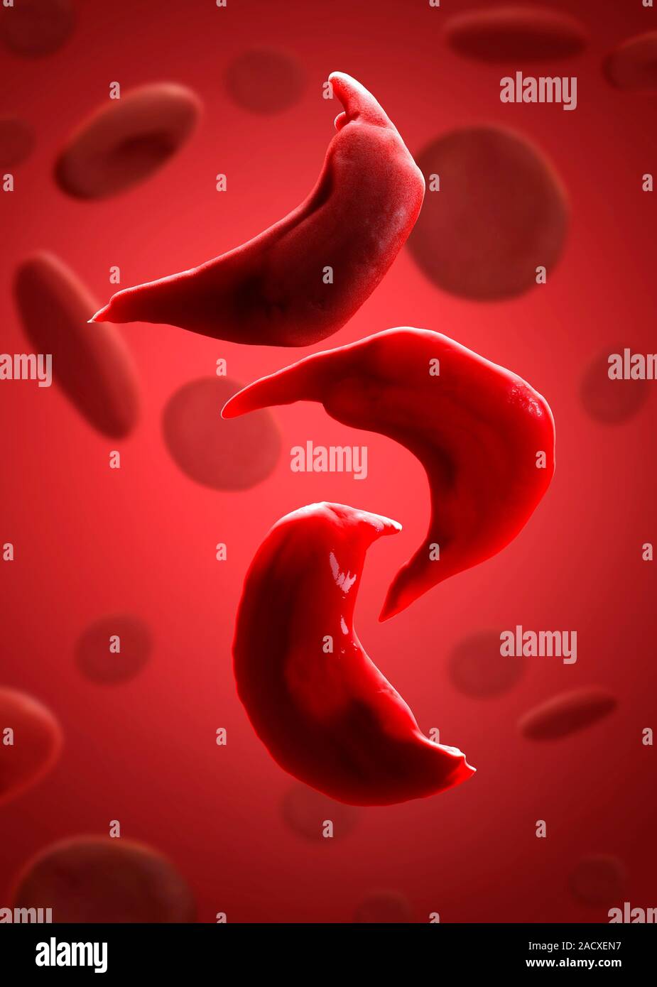 Sickle cell anaemia. Artwork showing normal red blood cells (round ...