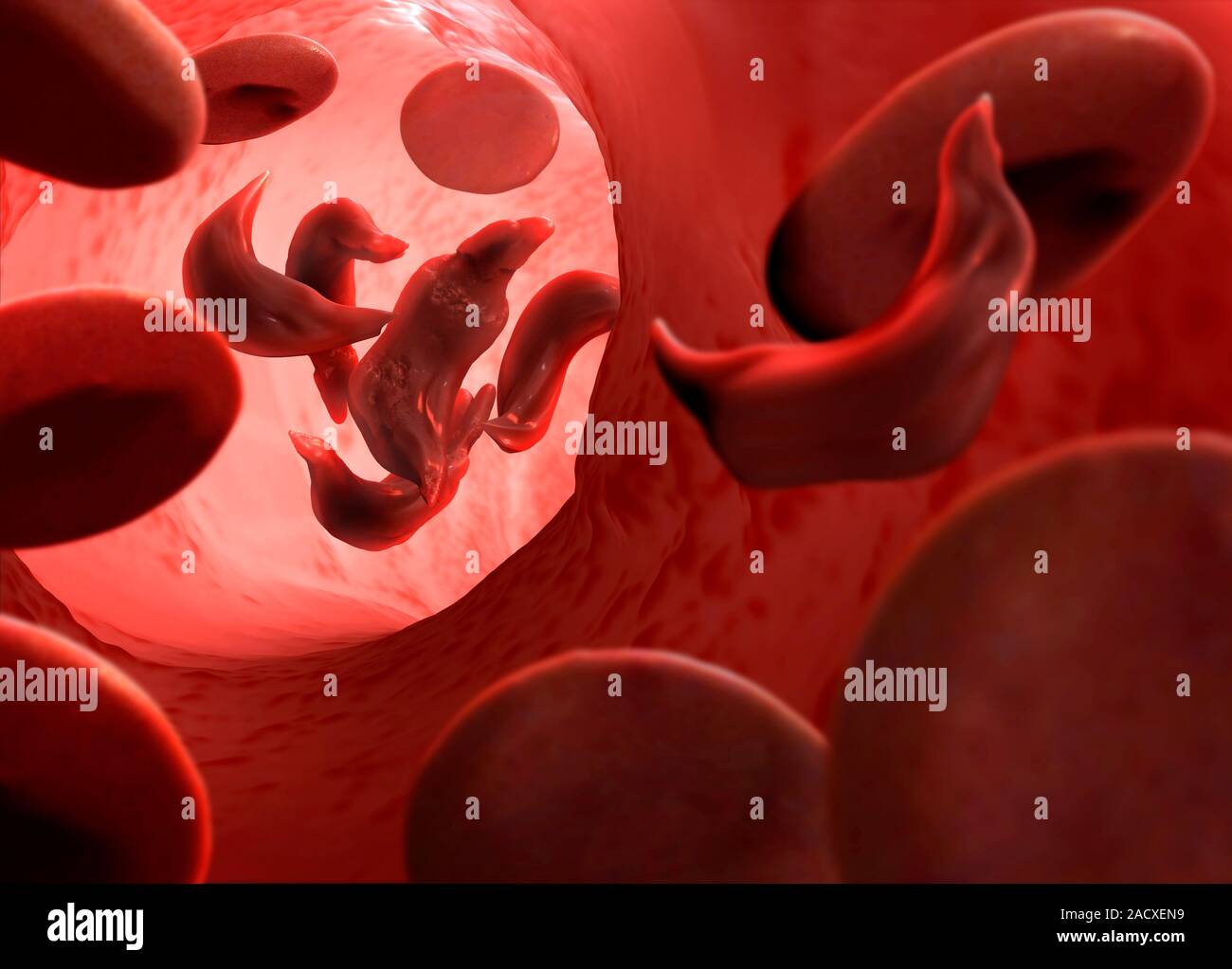Sickle cell anaemia. Artwork showing normal red blood cells (round ...