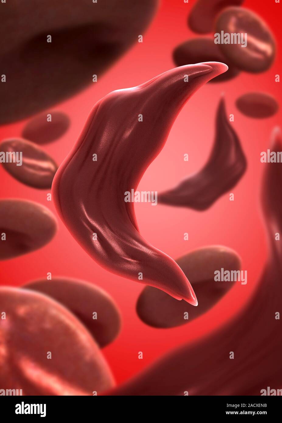 Sickle cell anaemia. Artwork showing normal red blood cells (round ...