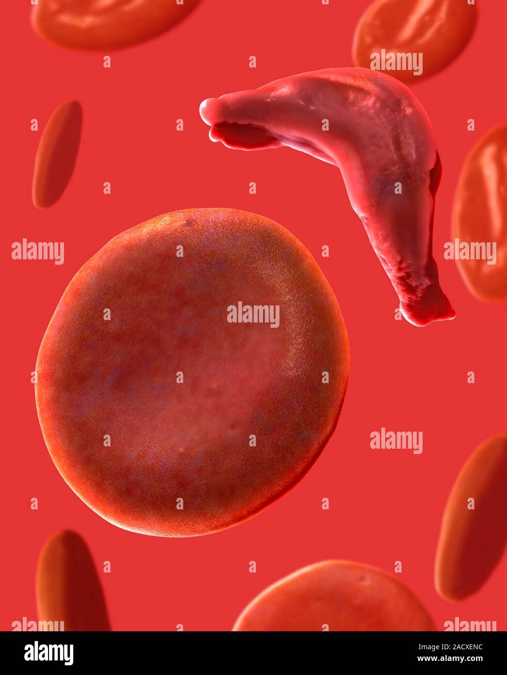 Sickle cell anaemia. Artwork showing normal red blood cells (round ...